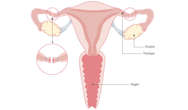 Stérilisation Contraceptive Avantages Et Inconvénients Acapros Fr